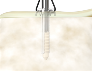 Soft Tissue Fixation System - CoNextions Medical