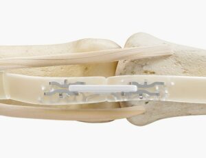 CoNextions TR Tendon Repair System