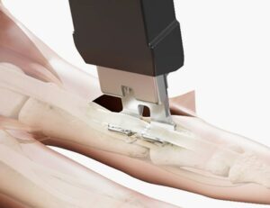 CoNextions TR Tendon Repair System